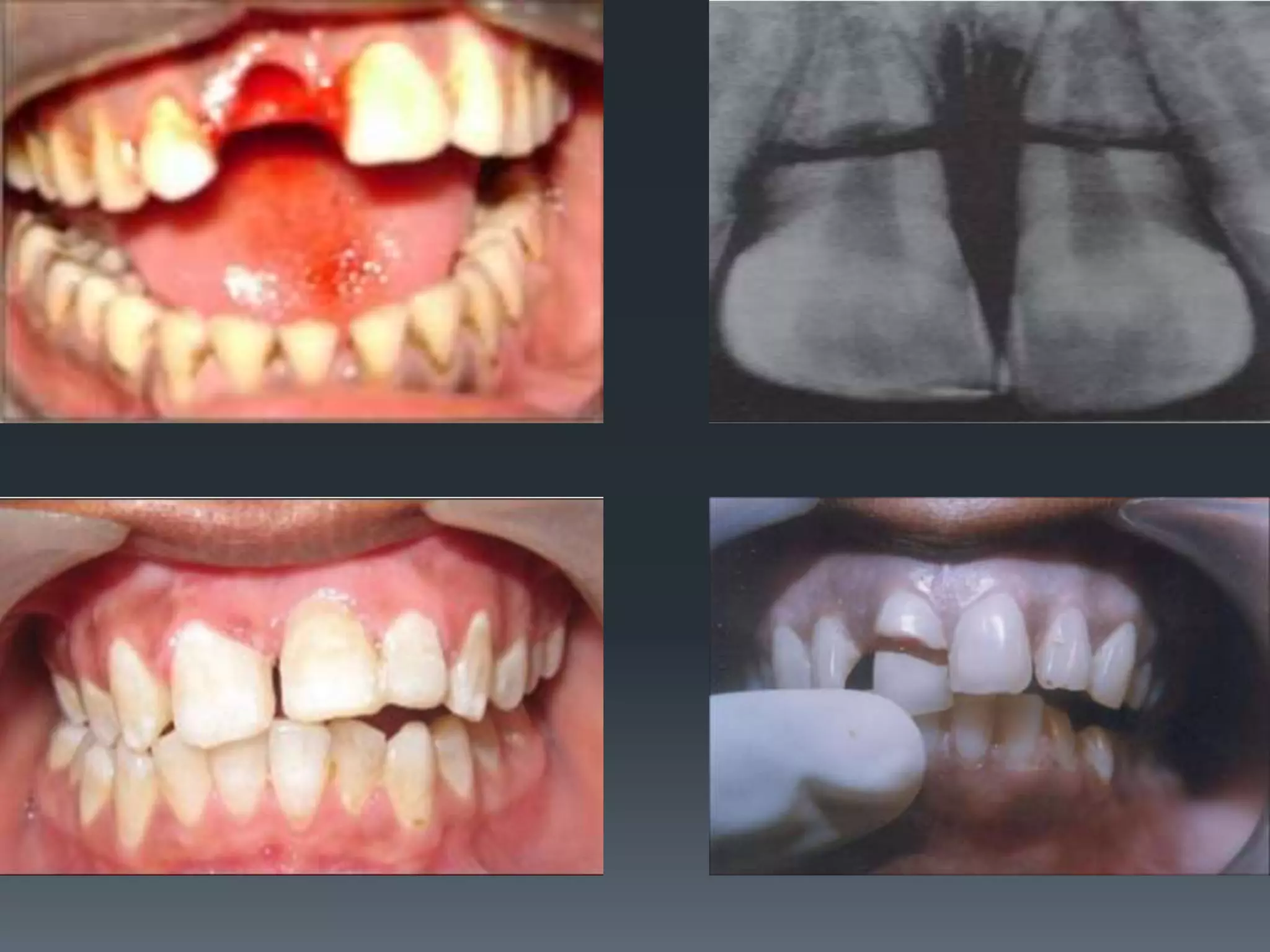 Dental Avulsion | PPTX