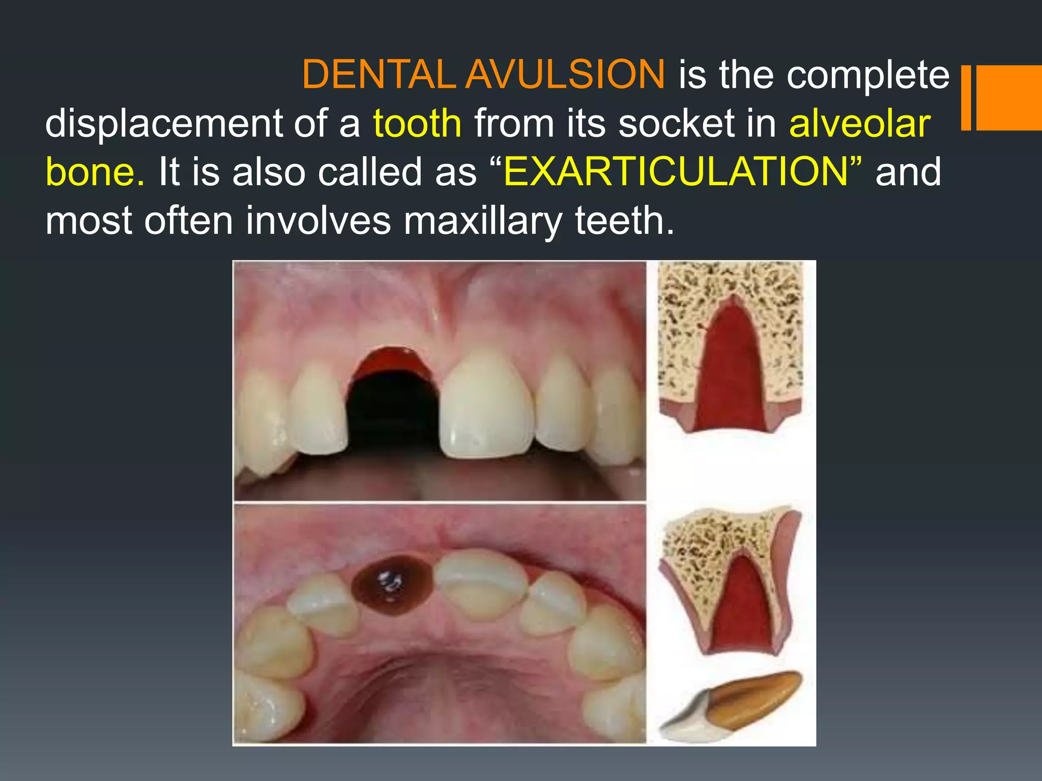 Dental Avulsion | PPTX