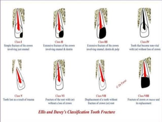 Dental Avulsion | PPTX