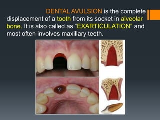 Dental Avulsion | PPTX
