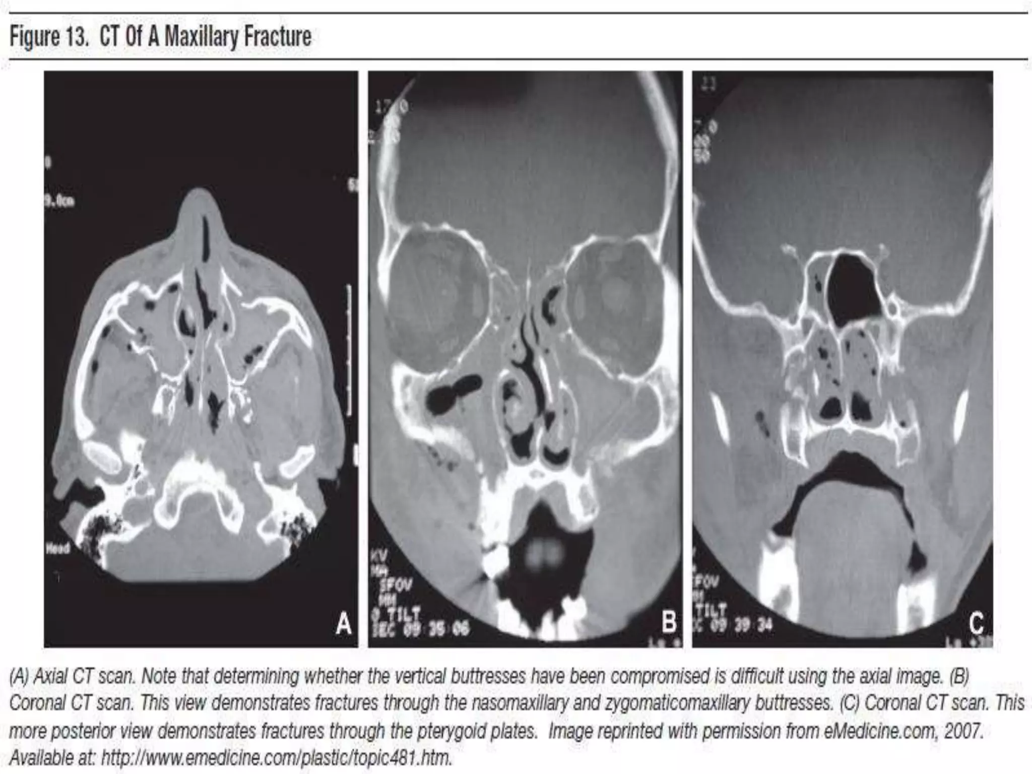 Fractures of middle third of face | PPTX
