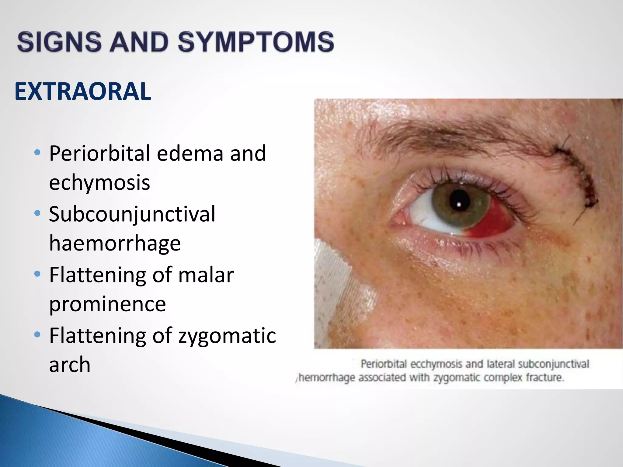 Fractures of middle third of face | PPTX