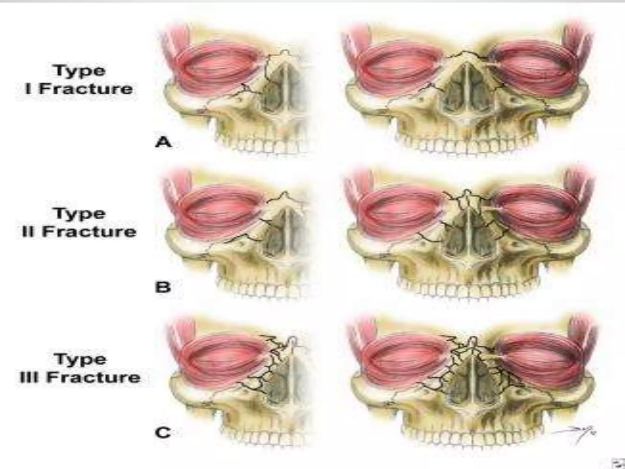 Fractures of middle third of face | PPTX