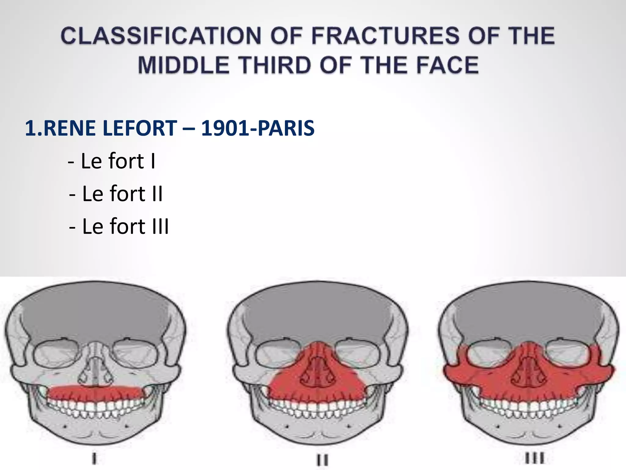 Fractures of middle third of face | PPTX