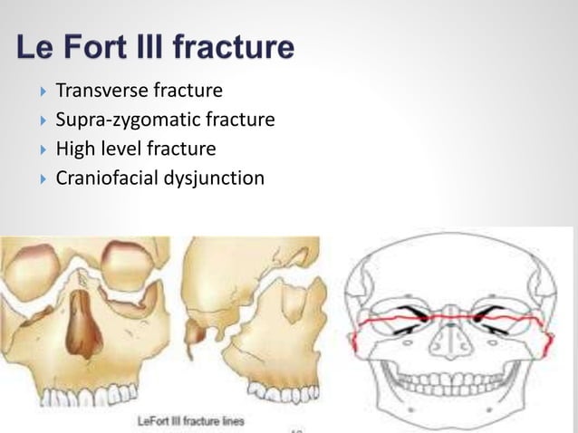 Fractures of middle third of face | PPTX | Death, Injury, or Military ...
