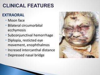 Fractures of middle third of face | PPTX