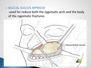 Fractures of middle third of face | PPTX