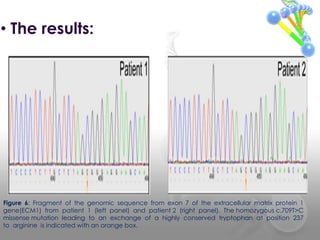 Urbach-Wiethe Syndrome Associated Fear Processing Defect | PPTX