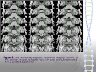 Urbach-Wiethe Syndrome Associated Fear Processing Defect | PPTX