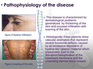 Urbach-Wiethe Syndrome Associated Fear Processing Defect | PPTX
