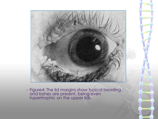 Urbach-Wiethe Syndrome Associated Fear Processing Defect | PPT