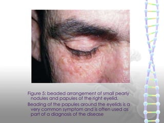 Urbach-Wiethe Syndrome Associated Fear Processing Defect | PPTX