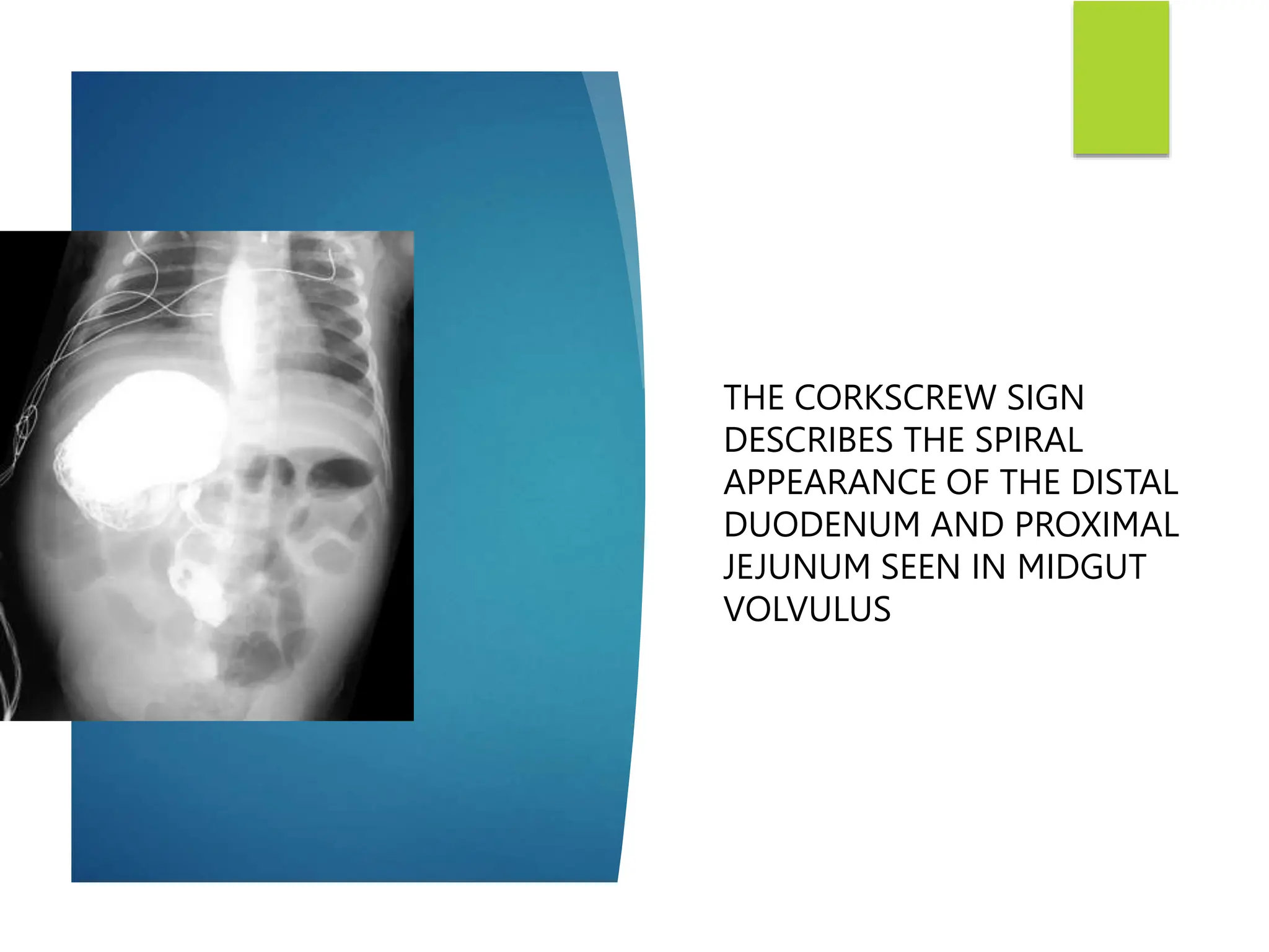 how to properly Manage of new born with vomiting | PPTX