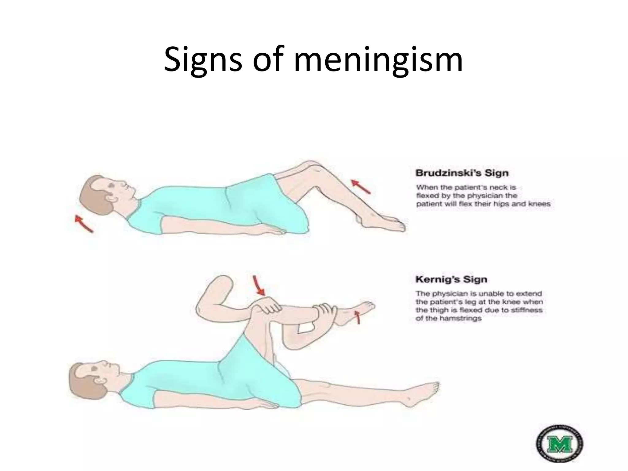 sub arachnoid hemorrhage | PPTX