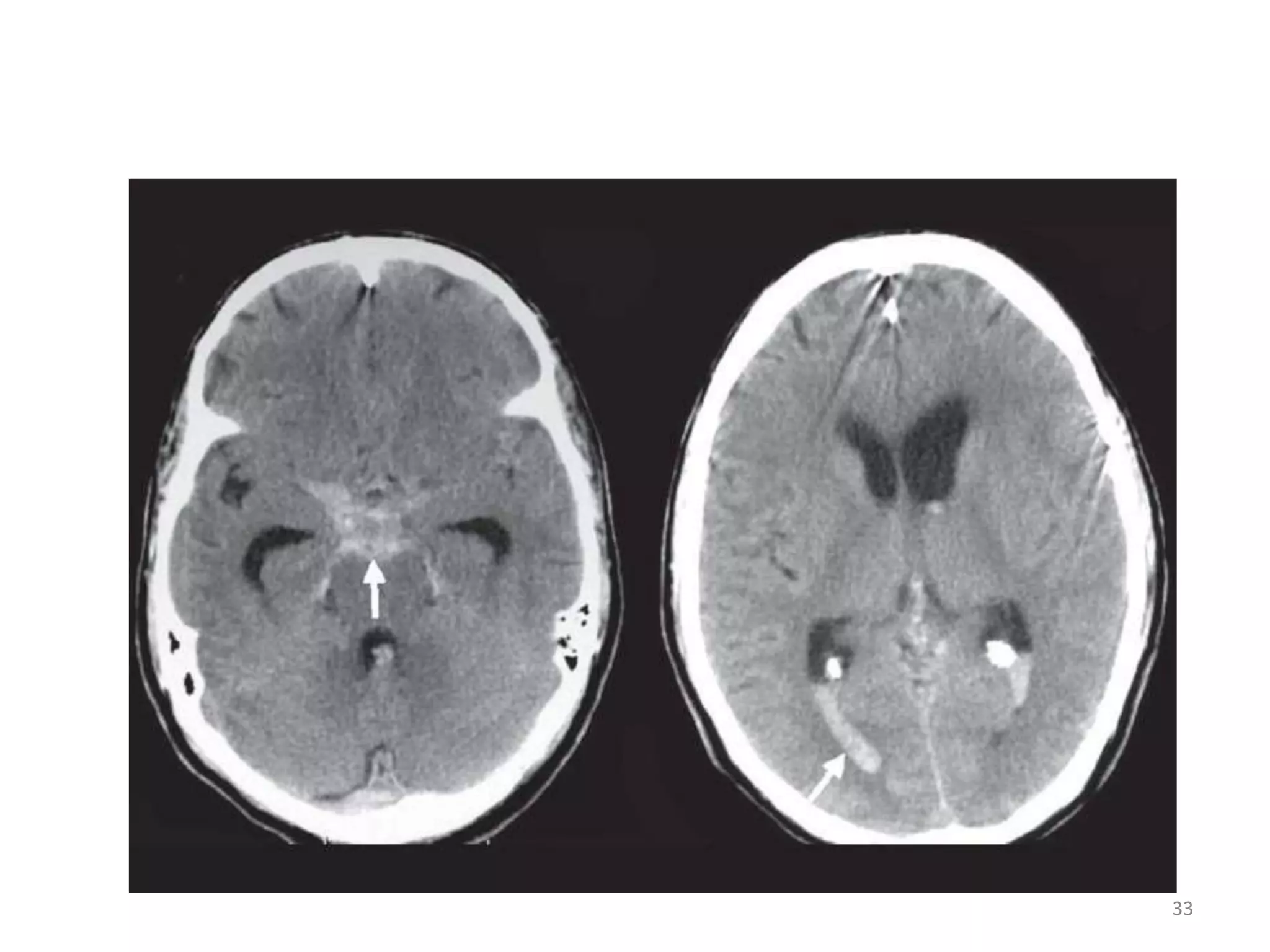 sub arachnoid hemorrhage | PPTX