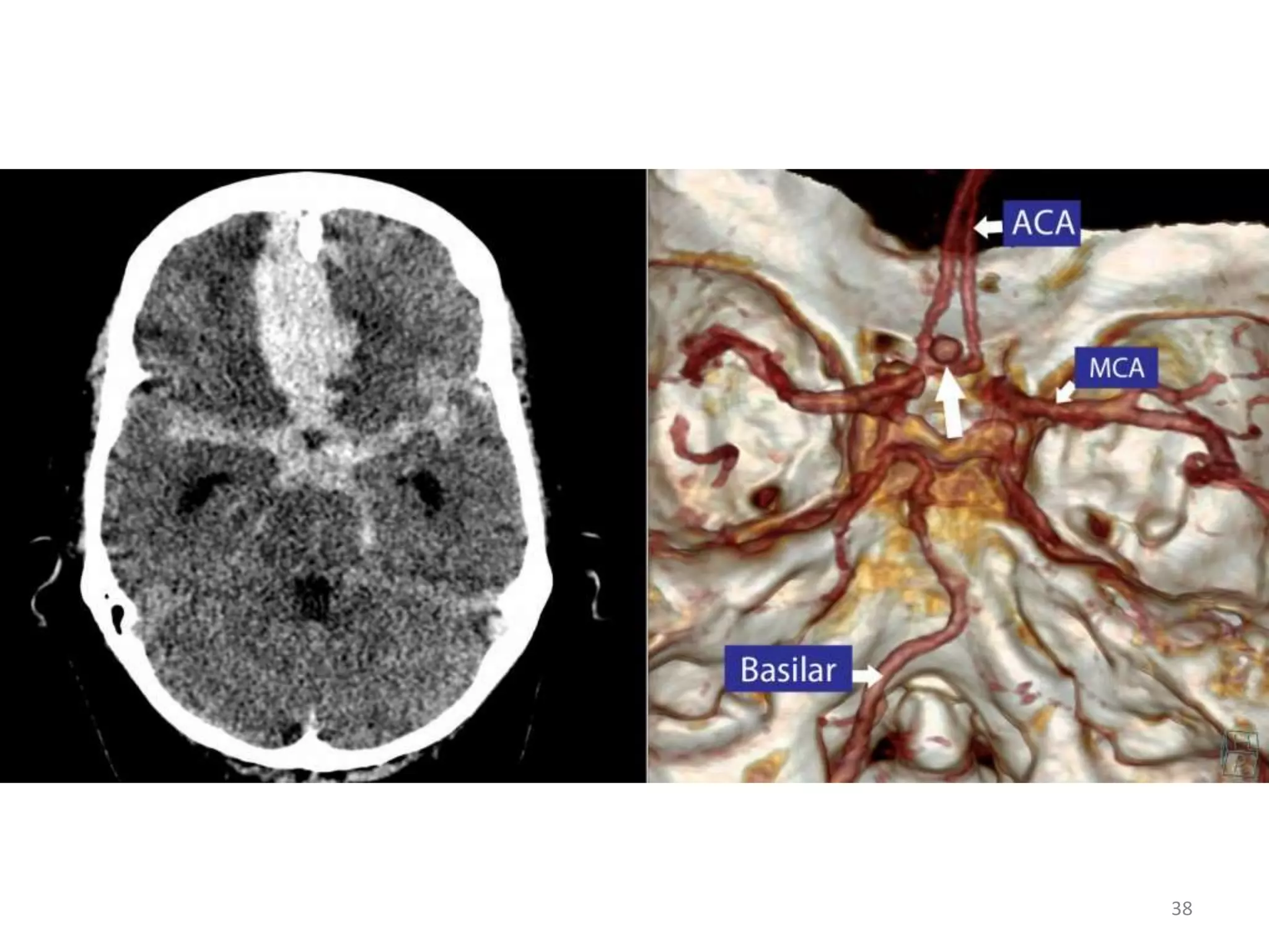 sub arachnoid hemorrhage | PPTX