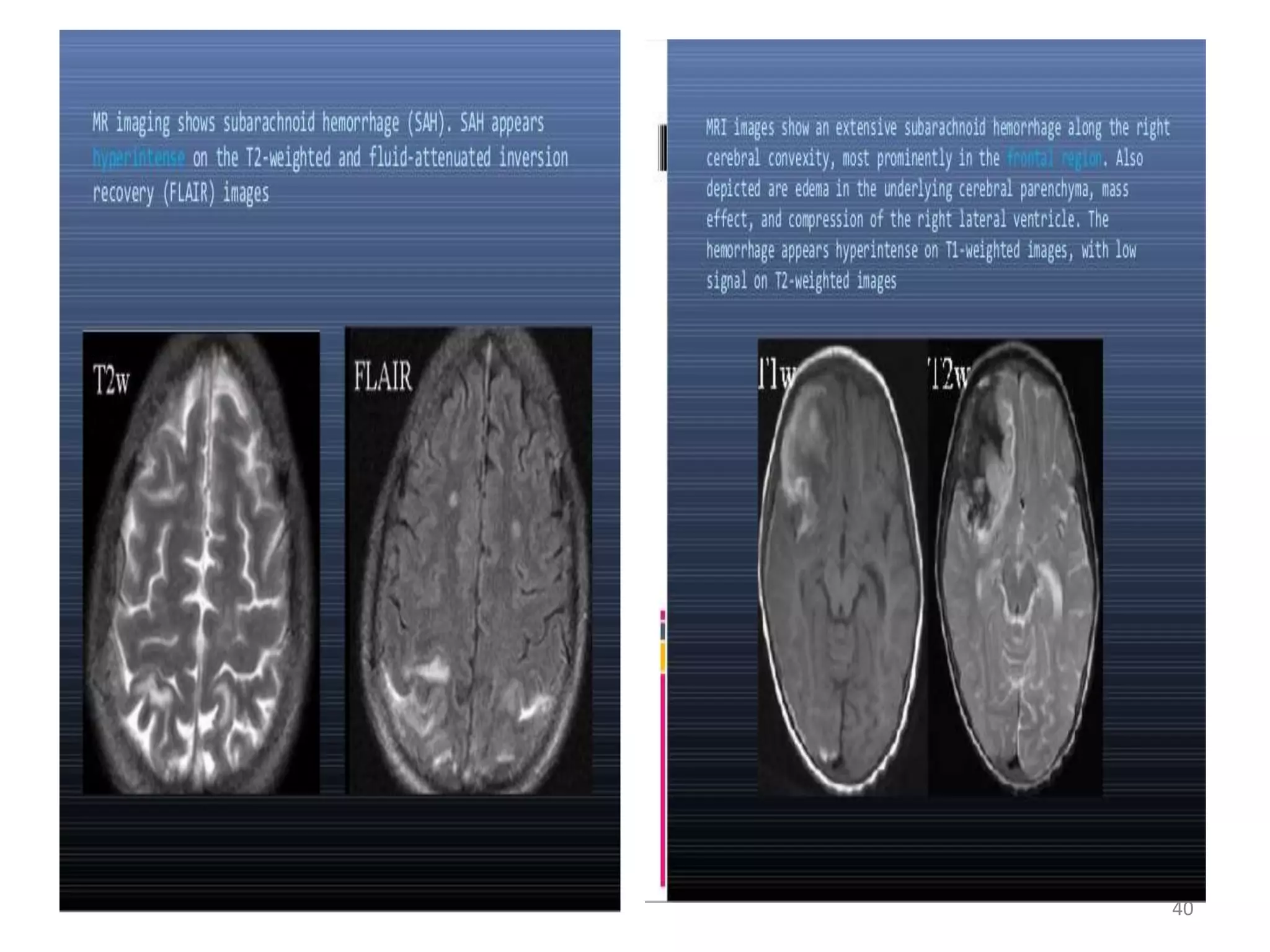 sub arachnoid hemorrhage | PPTX