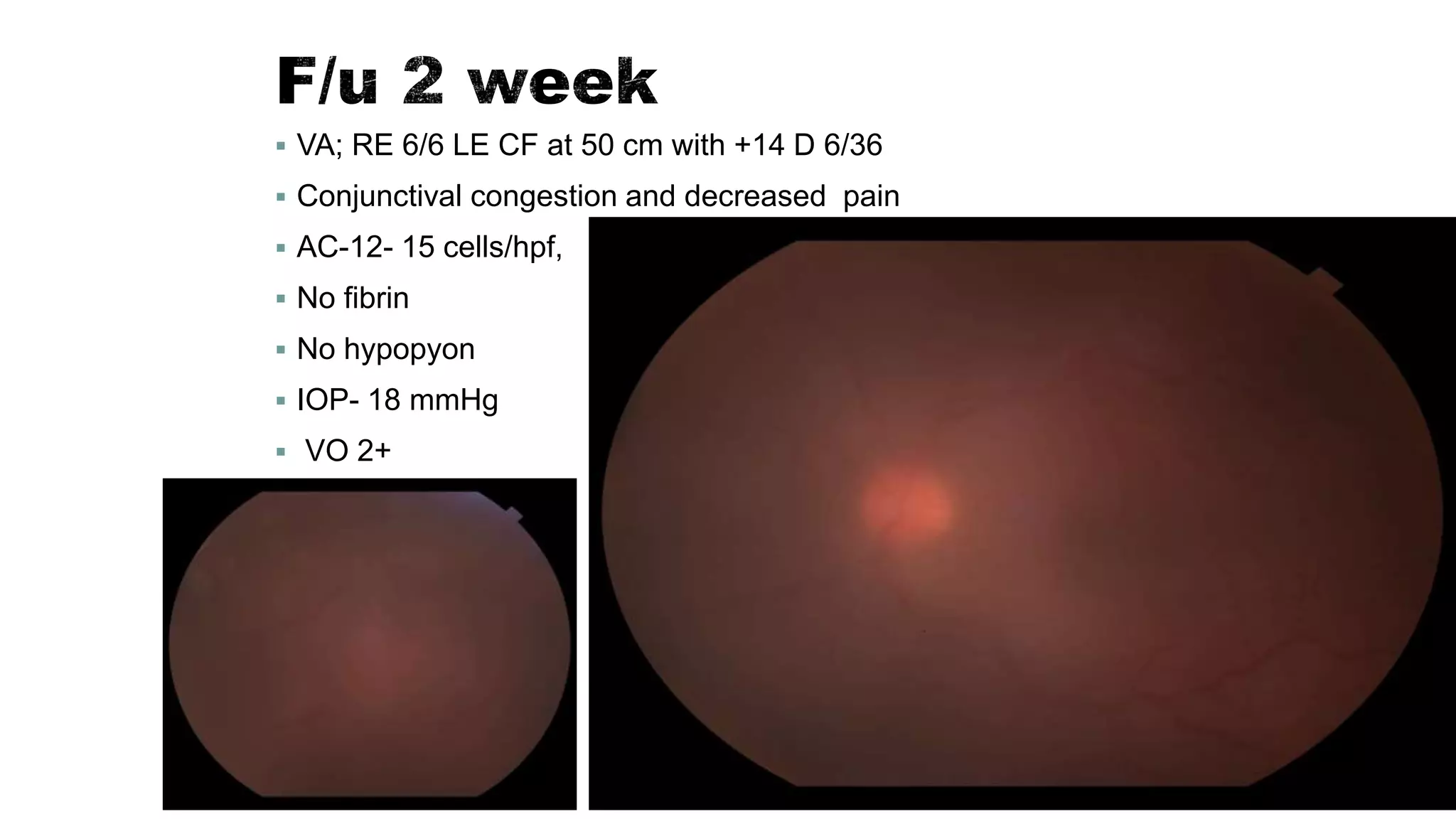 SHAPU ( Seasonal Hyperacute Panuveitis) case | PPTX