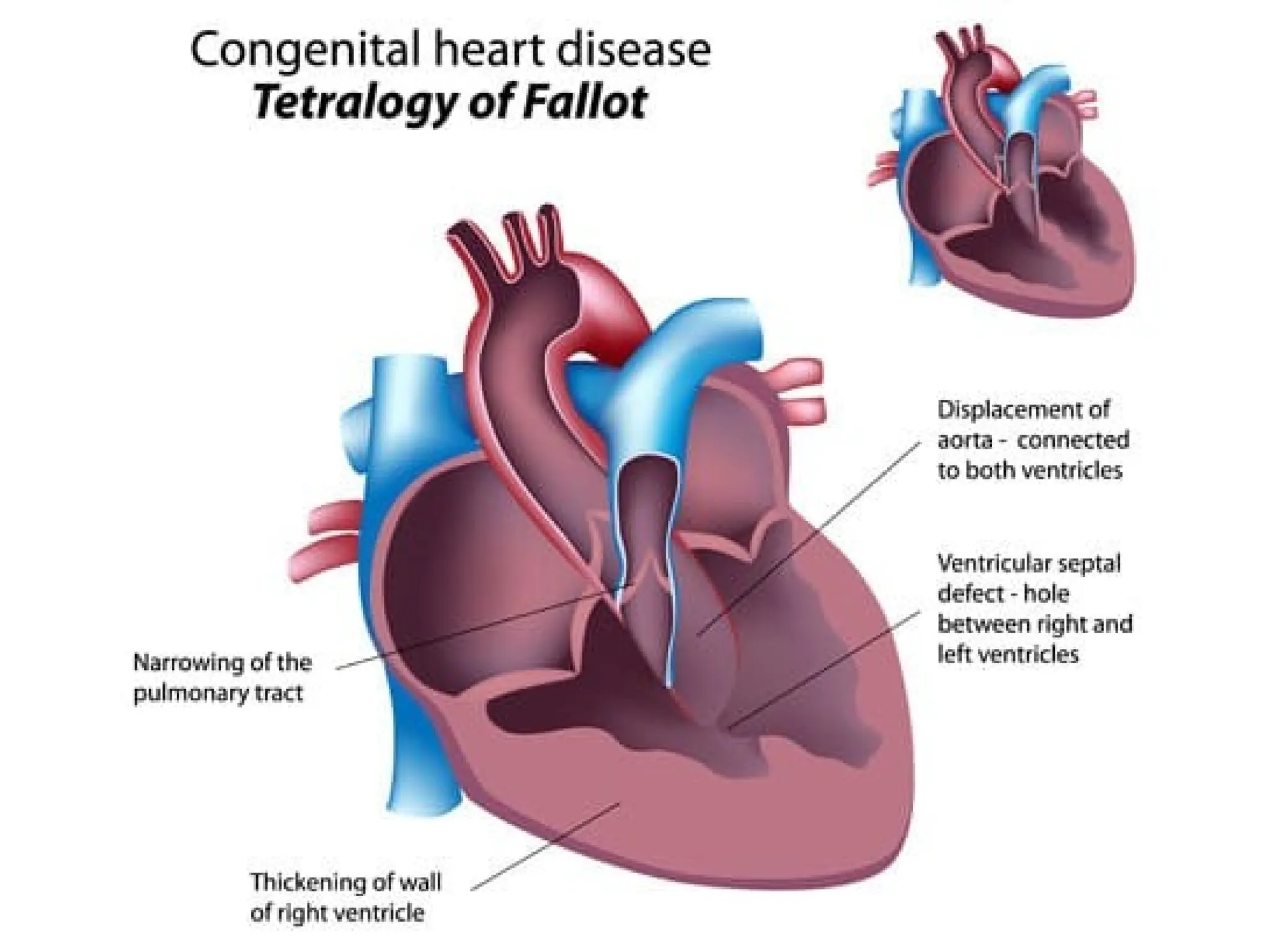 Congenital heart failure and fetal circulation.pptx