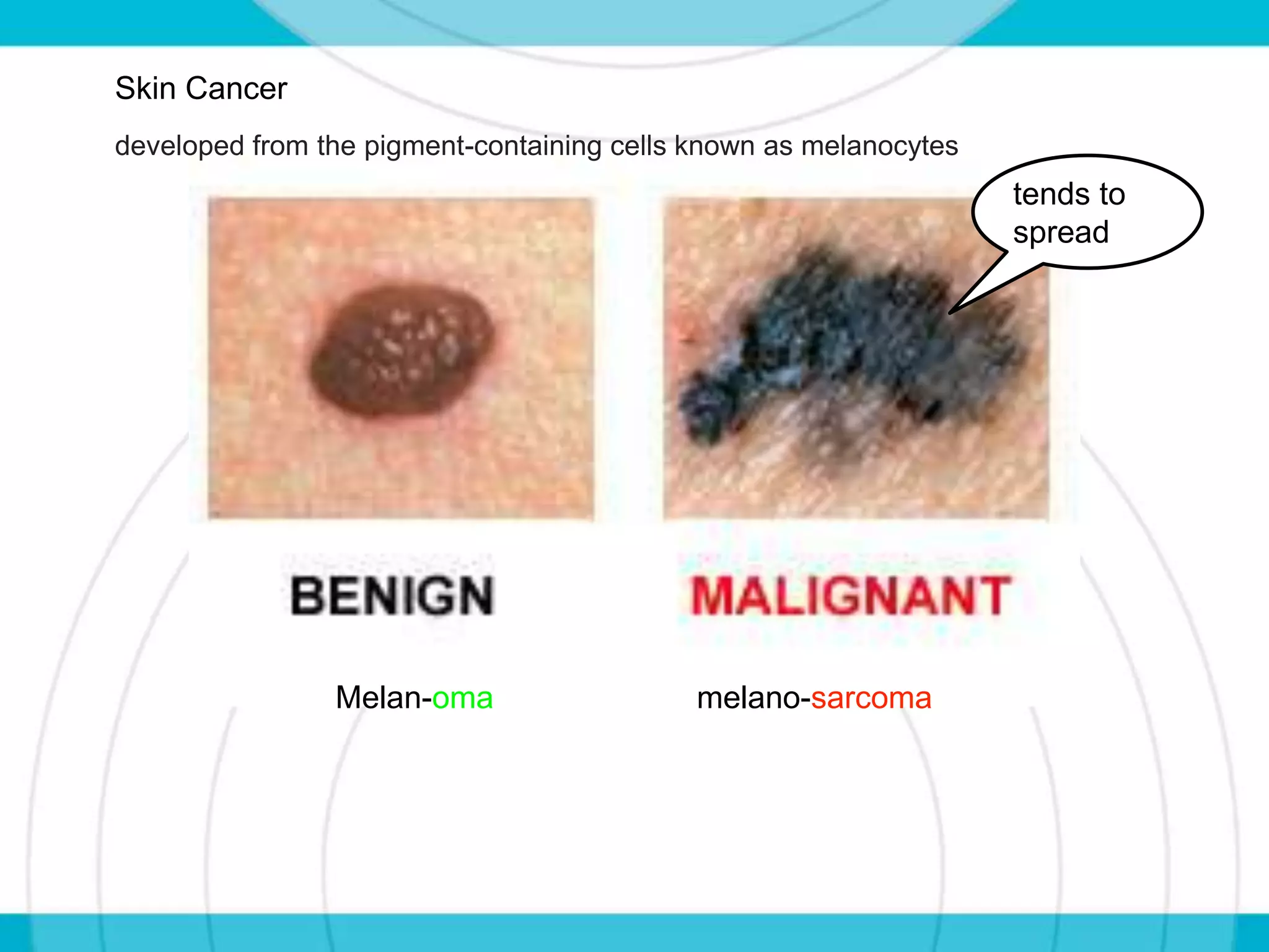 Malignant Tumor vs. Benign Tumor LAB | PPTX