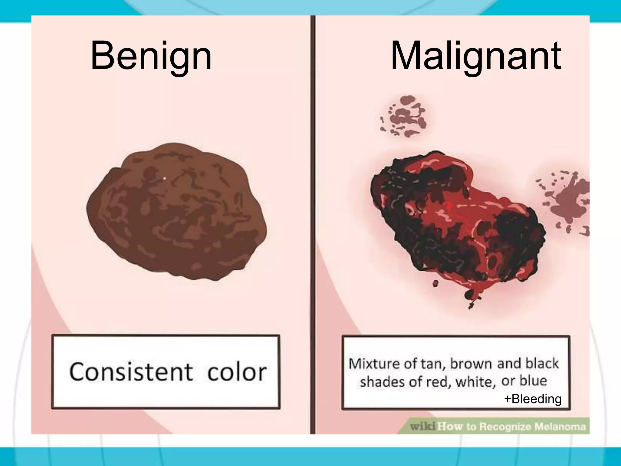 Malignant Tumor vs. Benign Tumor LAB | PPTX