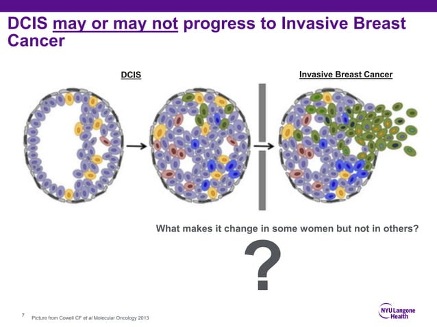 Topic-Driven Round Table on DCIS: What are Your Radiation Options? | PPT