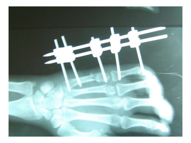 Hand fractures ppt by Dr Ahsan | PPTX | First Aid | Injuries