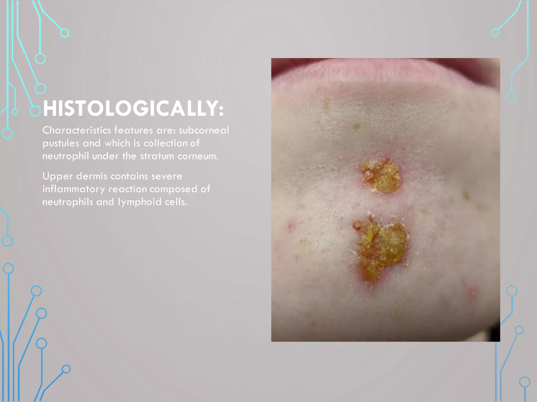 Infectious dermatoses-Pathology | PDF