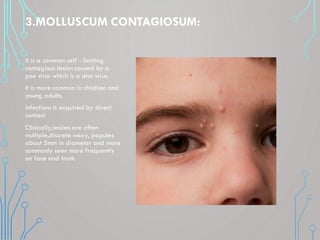 Infectious dermatoses-Pathology | PDF