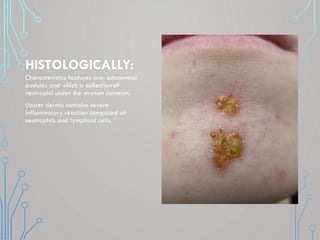 Infectious dermatoses-Pathology | PDF