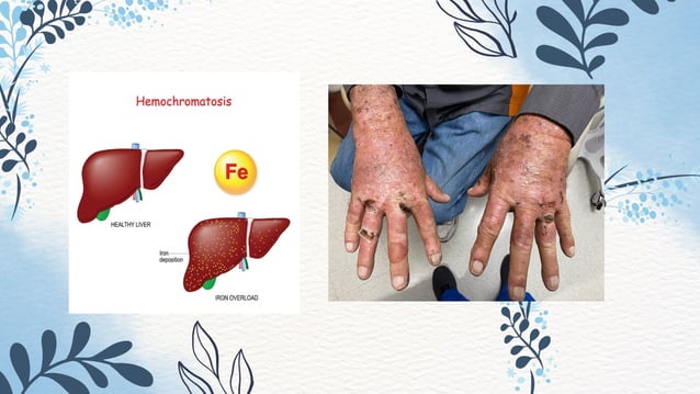 Share iron poisoning fatal dose treatment pptx | PPT