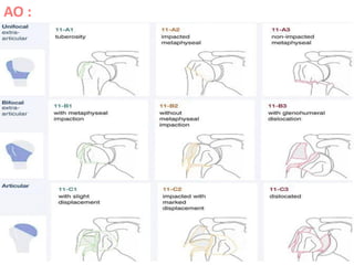 MIROS (Minimally Invasive Reduction and Osteosynthesis System®) | PDF