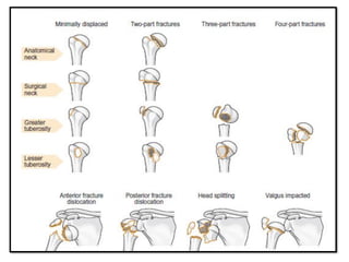 MIROS (Minimally Invasive Reduction and Osteosynthesis System®) | PDF