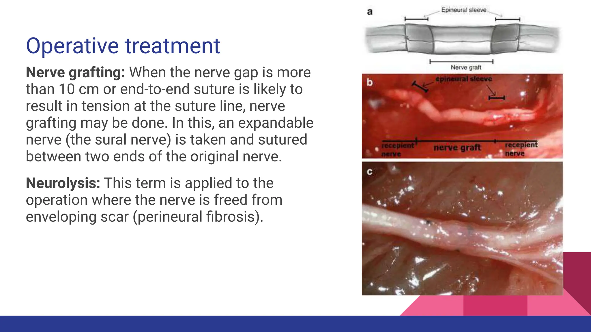 Share Peripheral nerve injuries ppt download | PDF