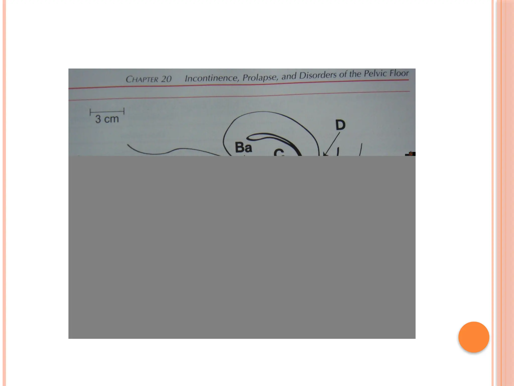 Share pop.pptx pelvic organ prolapse ppt | PPT