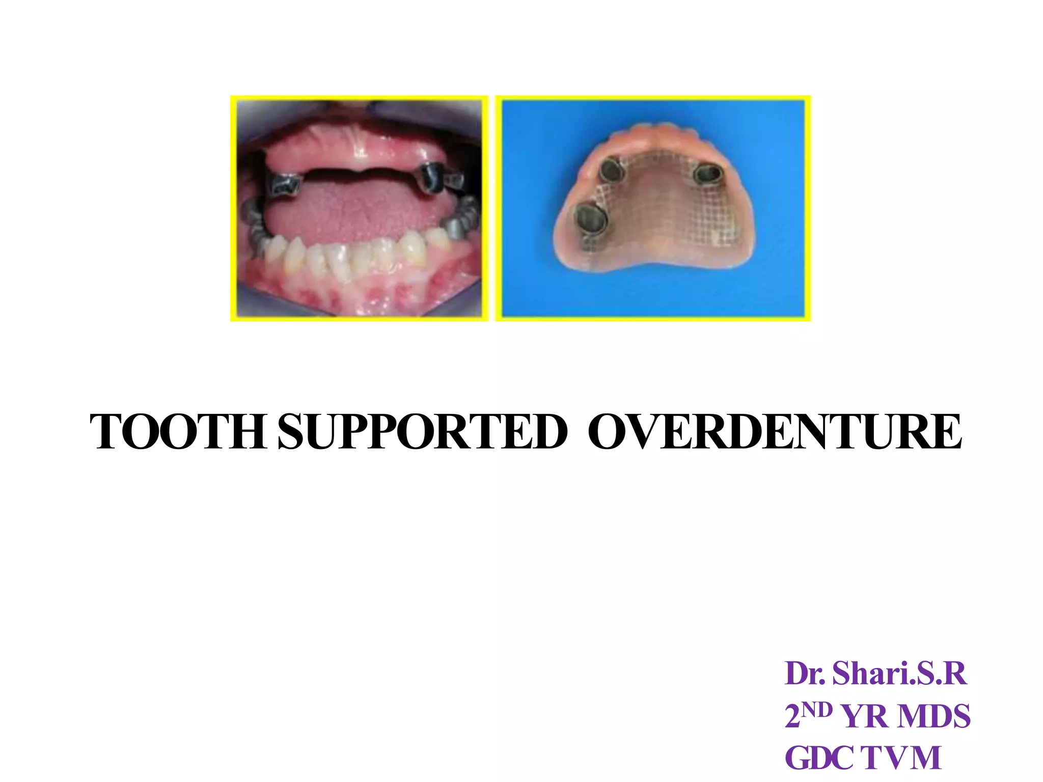 TOOTH SUPPORTED OVERDENTURE | PPTX