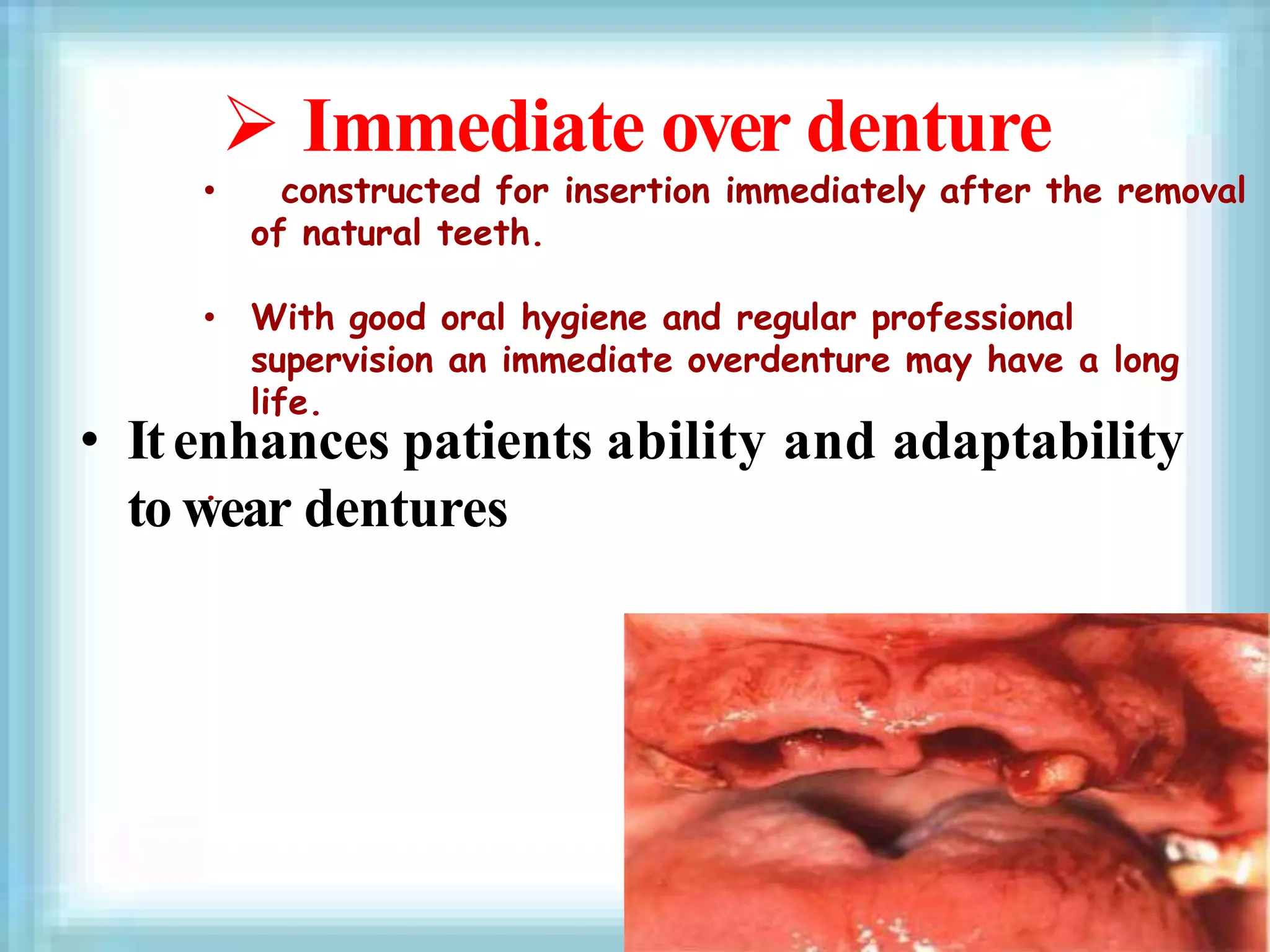 TOOTH SUPPORTED OVERDENTURE | PPTX