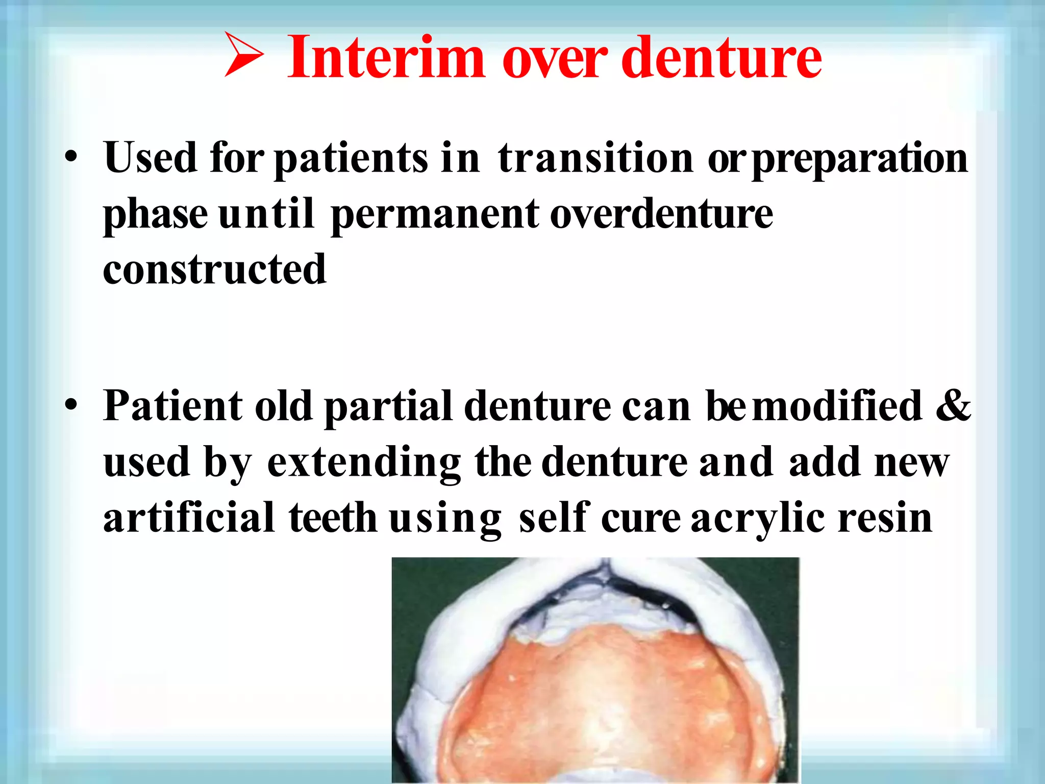 TOOTH SUPPORTED OVERDENTURE | PPTX | Dental Health | Diseases and ...