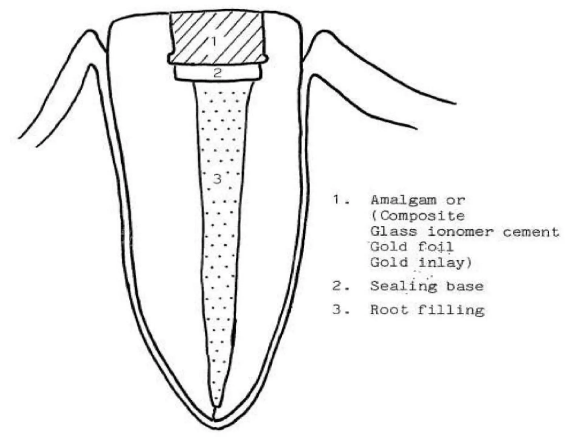 TOOTH SUPPORTED OVERDENTURE | PPTX