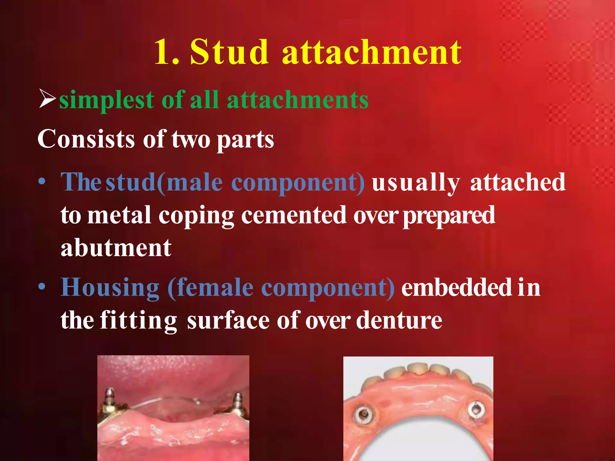 TOOTH SUPPORTED OVERDENTURE | PPTX
