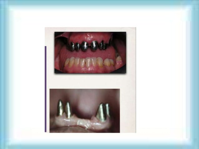 TOOTH SUPPORTED OVERDENTURE | PPTX | Dental Health | Diseases and ...