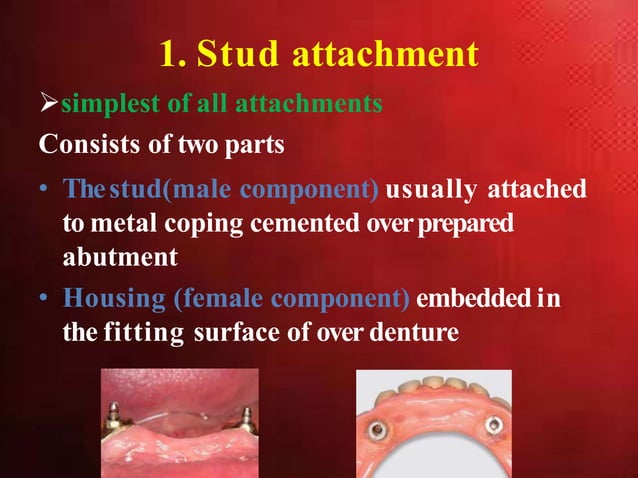 TOOTH SUPPORTED OVERDENTURE | PPTX | Dental Health | Diseases and ...
