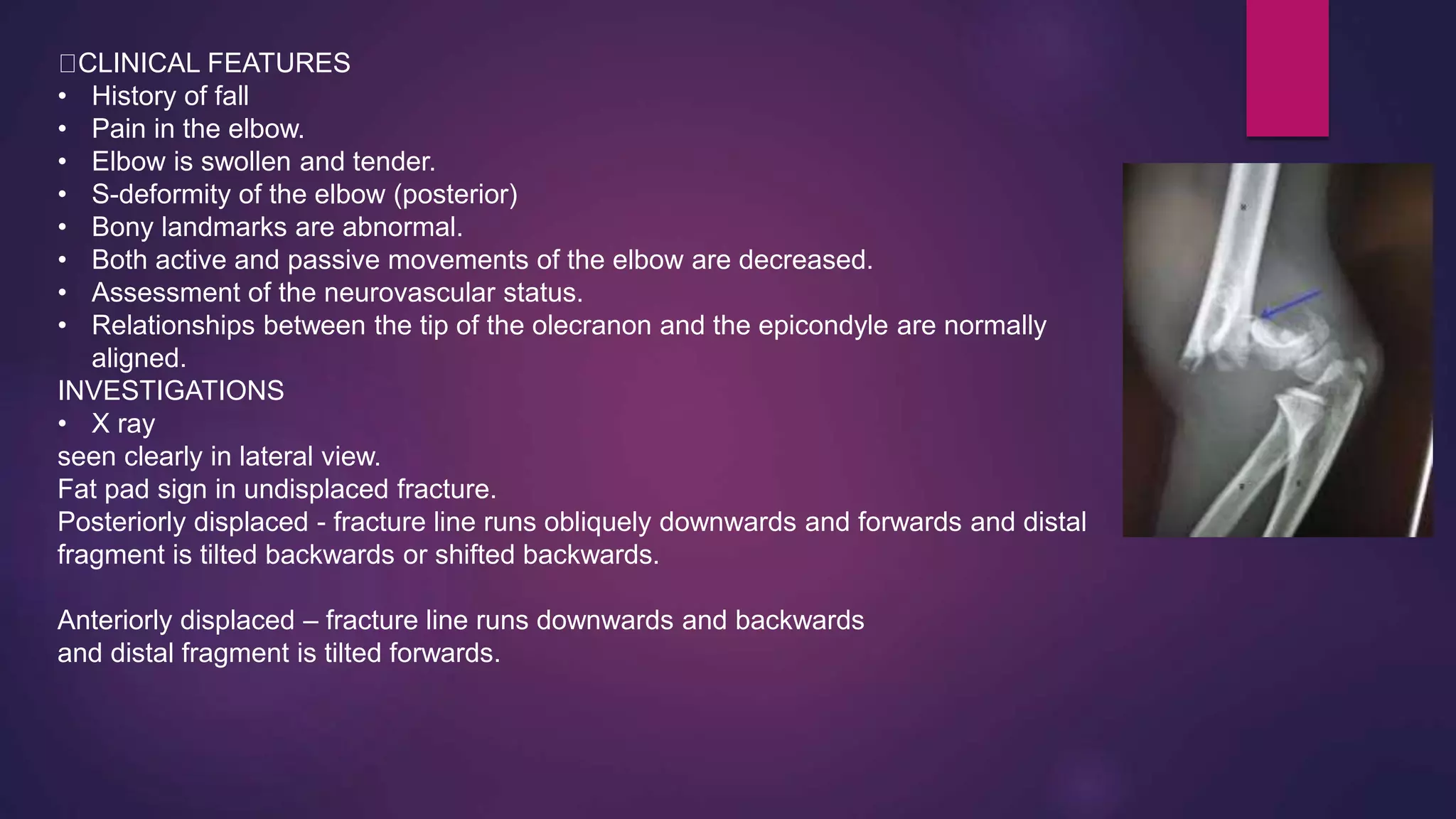 humerus fracture | PPTX