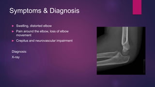 humerus fracture | PPTX
