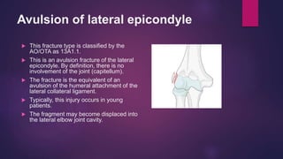 humerus fracture | PPTX