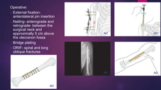 humerus fracture | PPTX