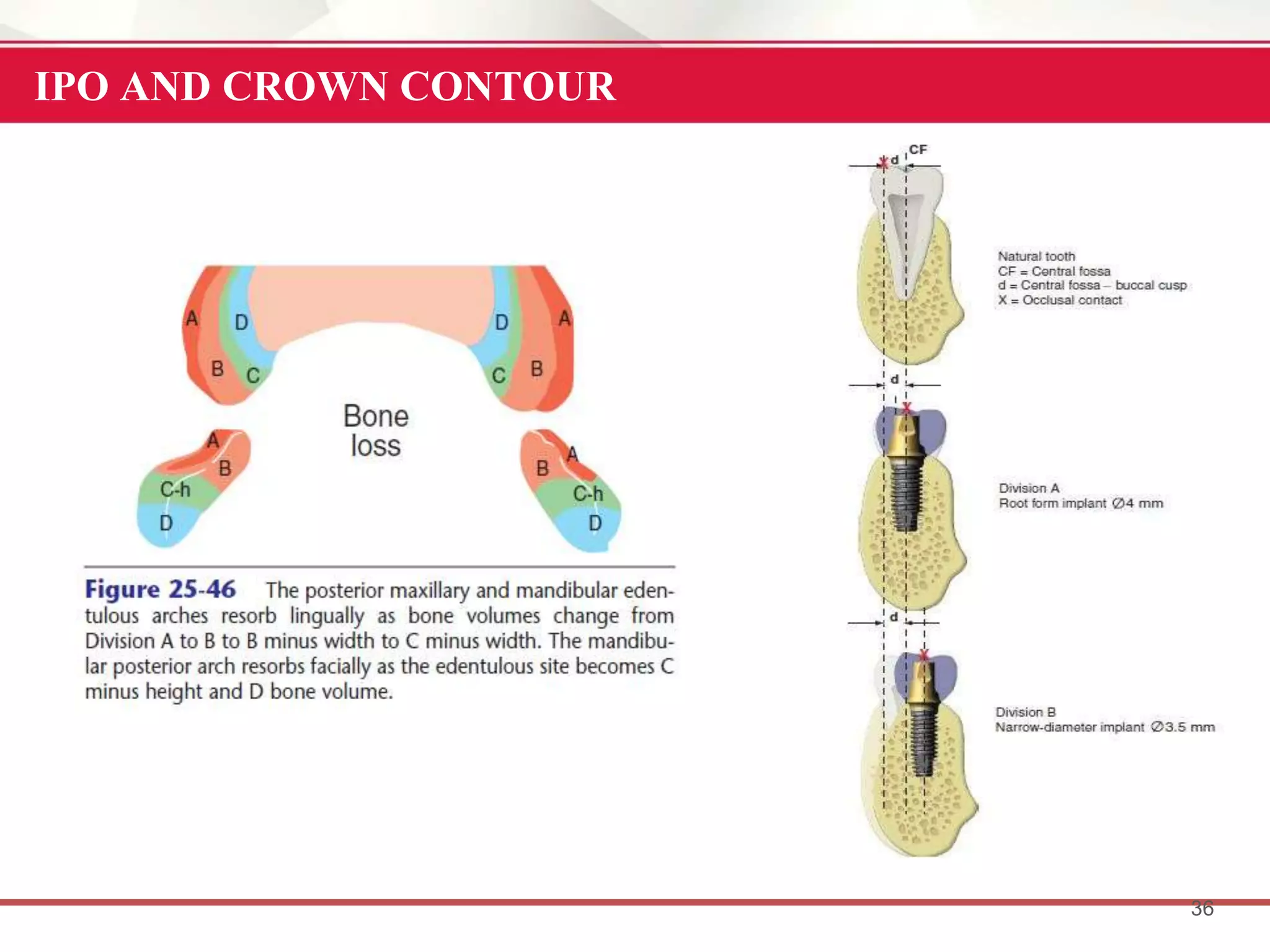 IMPLANT OCCLUSION | PPTX