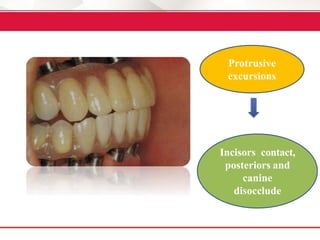 IMPLANT OCCLUSION | PPTX