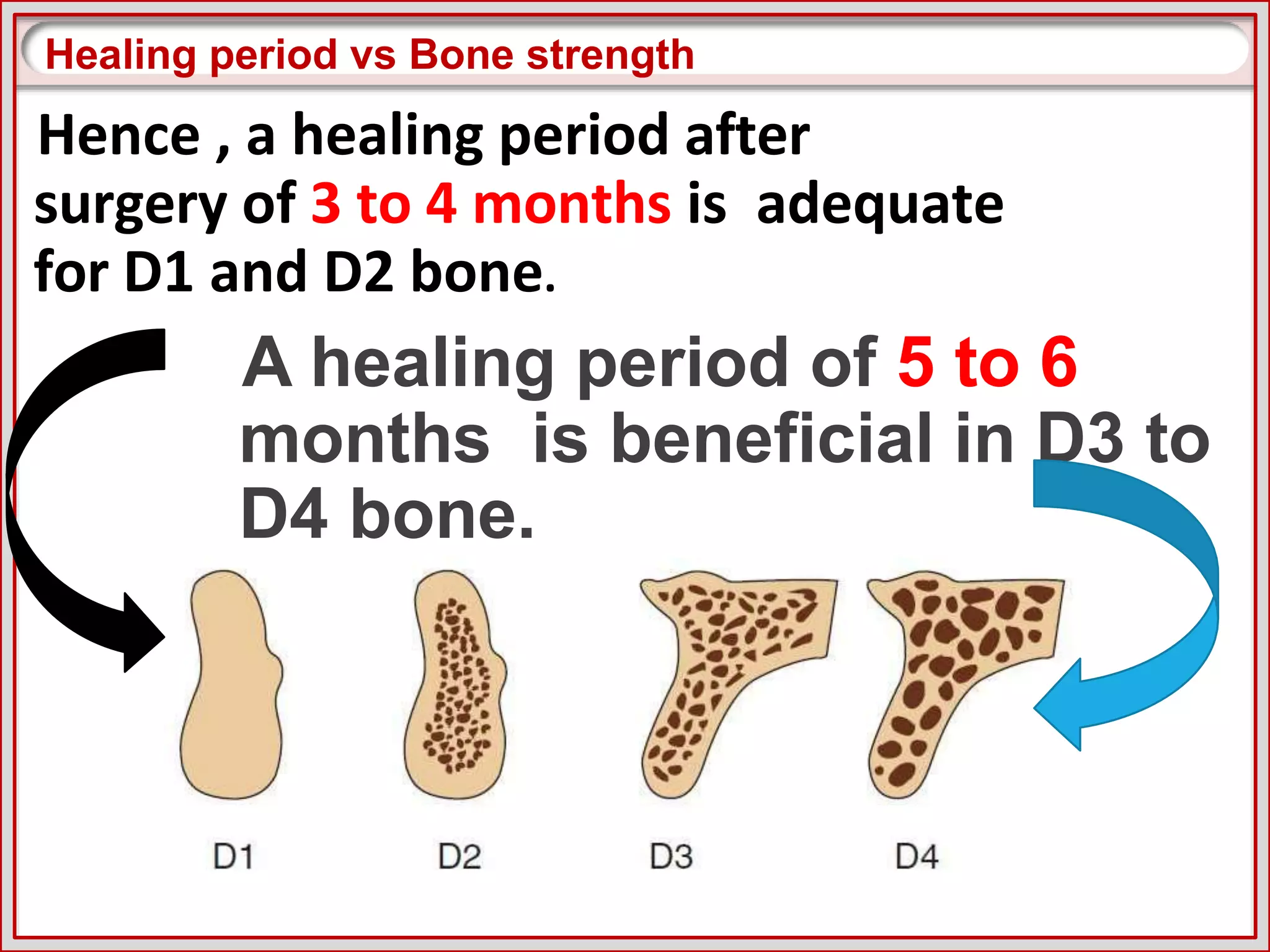 PROGRESSIVE LOADING IN IMPLANTS | PPTX