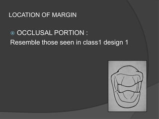 Modifications of Class 2 Cavity preparations | PPTX